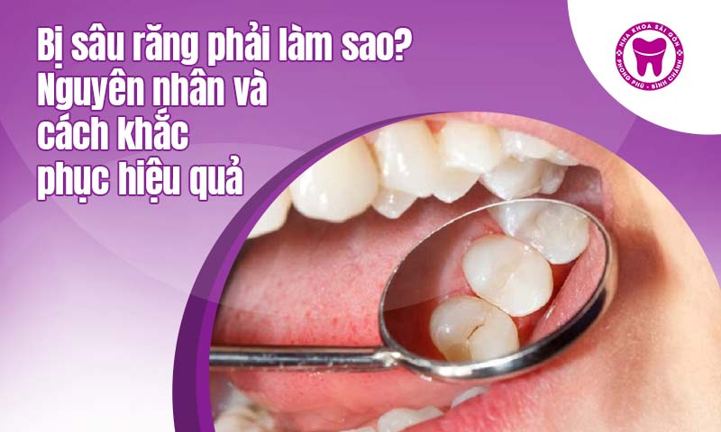 Bị sâu răng phải làm sao? Nguyên nhân và cách khắc phục hiệu quả - Nha ...