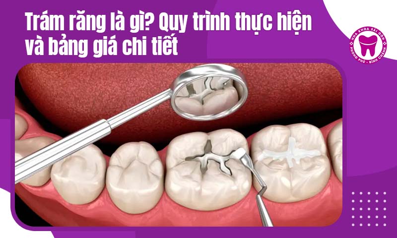 Trám răng là gì? Quy trình thực hiện và bảng giá chi tiết - Nha khoa ...