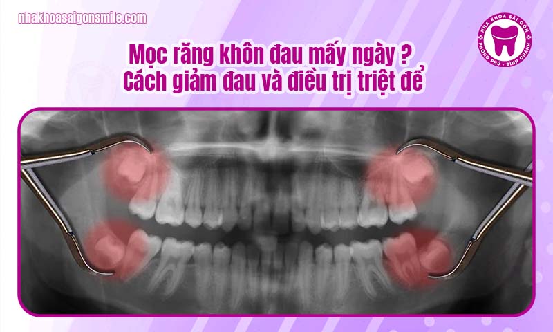 Mọc răng khôn đau mấy ngày? Cách giảm đau và điều trị triệt để - Nha ...
