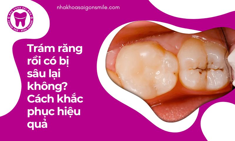 Trám răng rồi có bị sâu lại không ? Cách khắc phục hiệu quả - Nha khoa ...